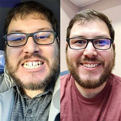 Invisalign To Close Gaps Between The Teeth | Whites Dental