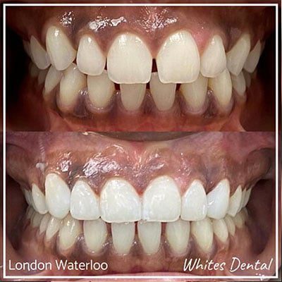 Invisalign To Close Gaps Between The Teeth | Whites Dental