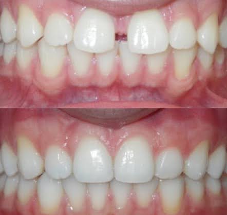 Invisalign London | Whites Dental Invisalign London