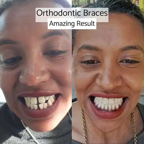 Fixed Braces Before And After | Pictures & Results | Whites Dental